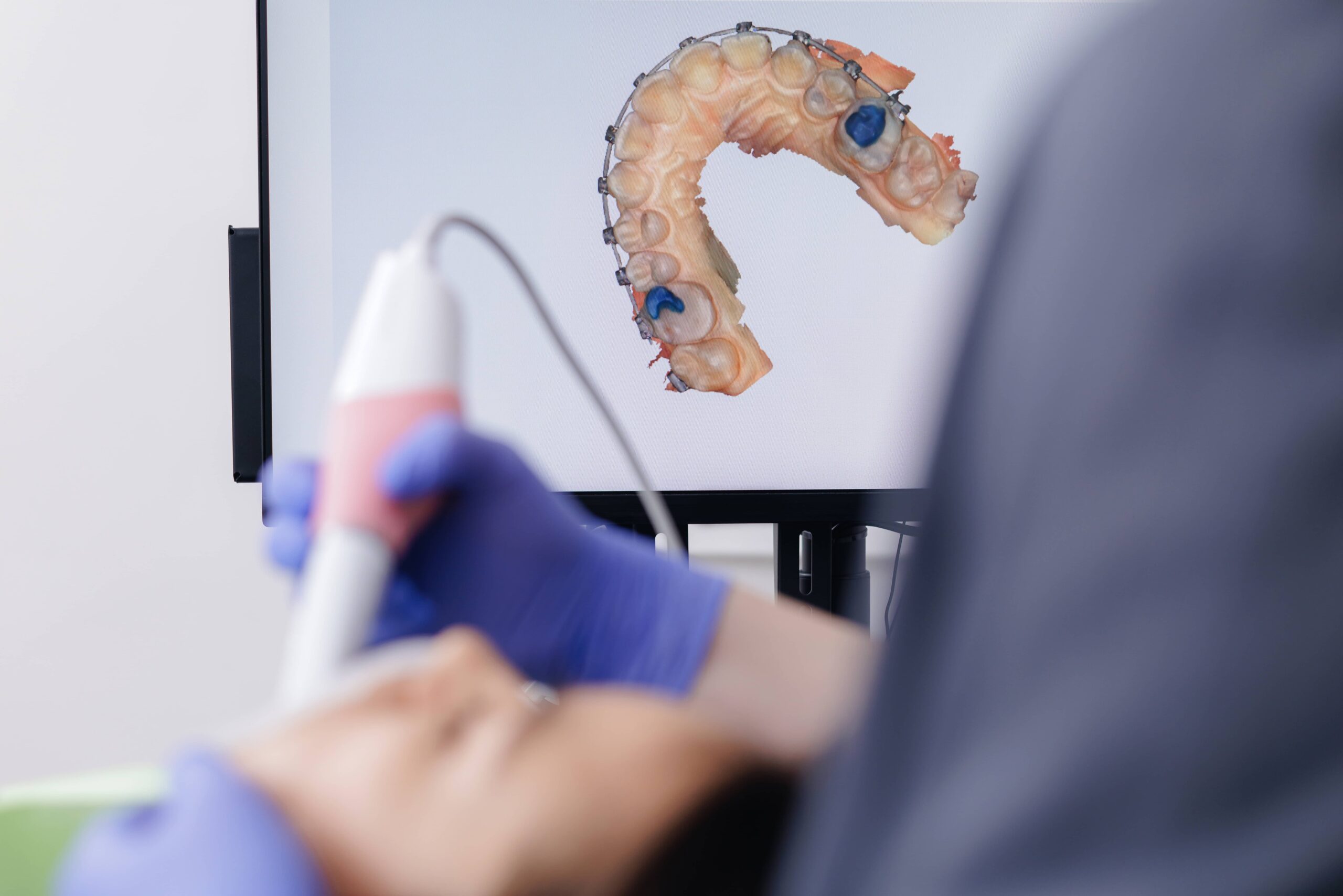 How Digital Scanning Changed Orthodontic Treatment - Melbourne Orthodontics
