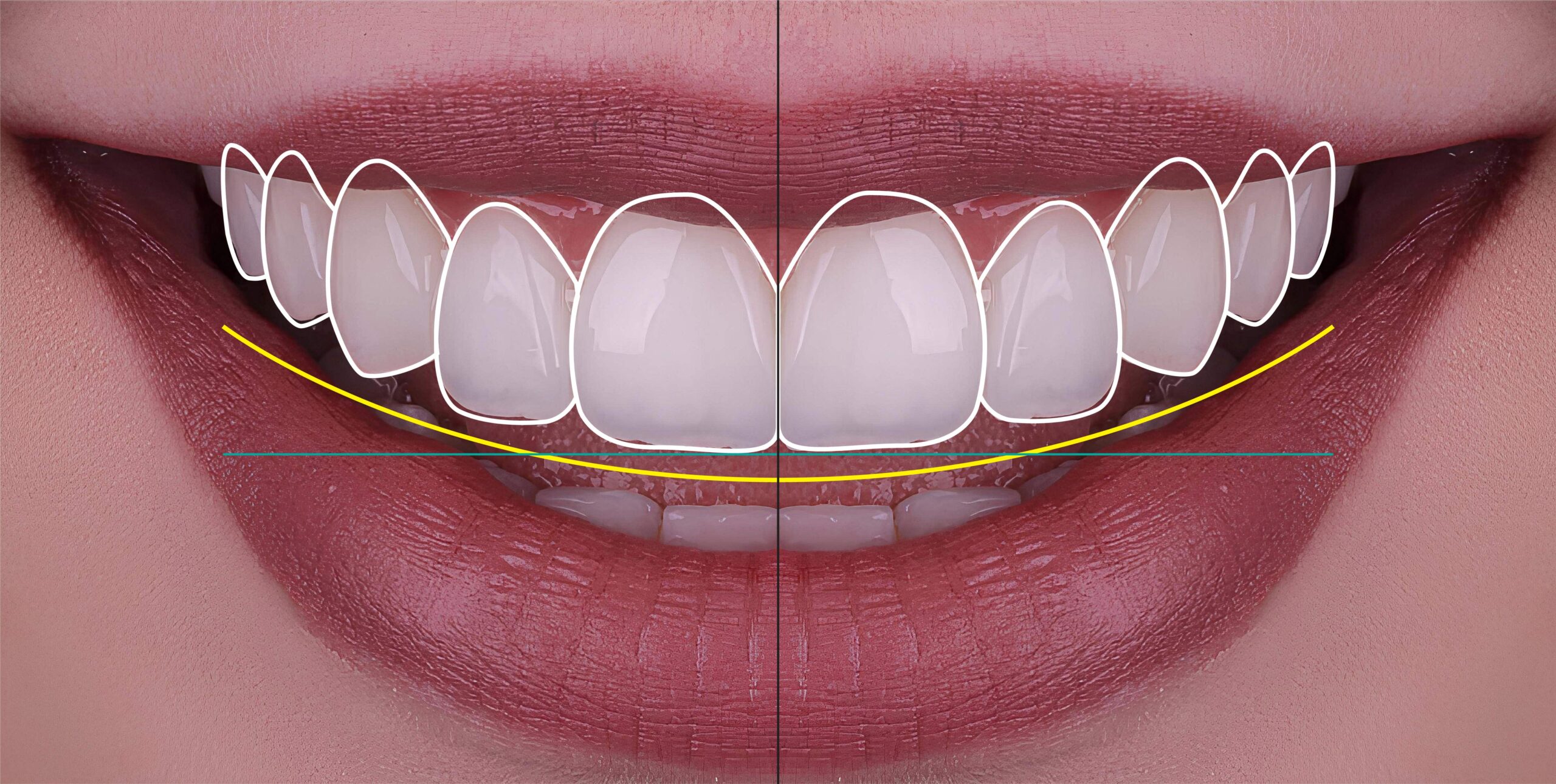 How Bite Alignment Affects Daily Comfort - Melbourne Orthodontics